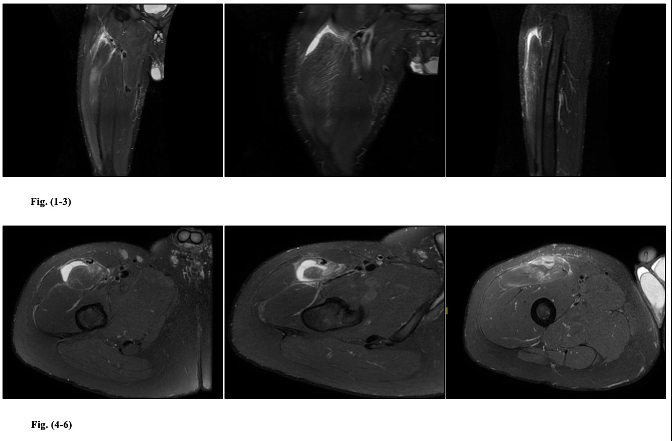 Grade III Direct Head of Rectus Femoris Myotendinous Tear in a ...