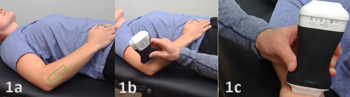 Diagnostic Musculoskeletal Ultrasound for the Evaluation of the Lateral ...
