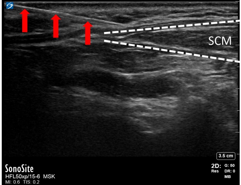 Peripheral Nerve Stimulation of the Lesser Occipital and Greater ...