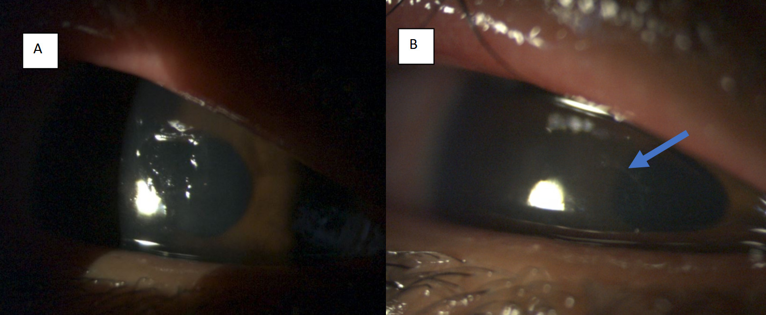 A Case Series of Geographic Corneal Epithelial Defects Secondary to ...