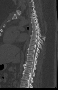 Diffuse Spinal Hyperostosis Causing Severe Spinal Stenosis and Thoracic ...
