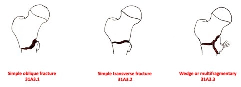 Cephalomedullary nailing for reverse oblique intertrochanteric ...