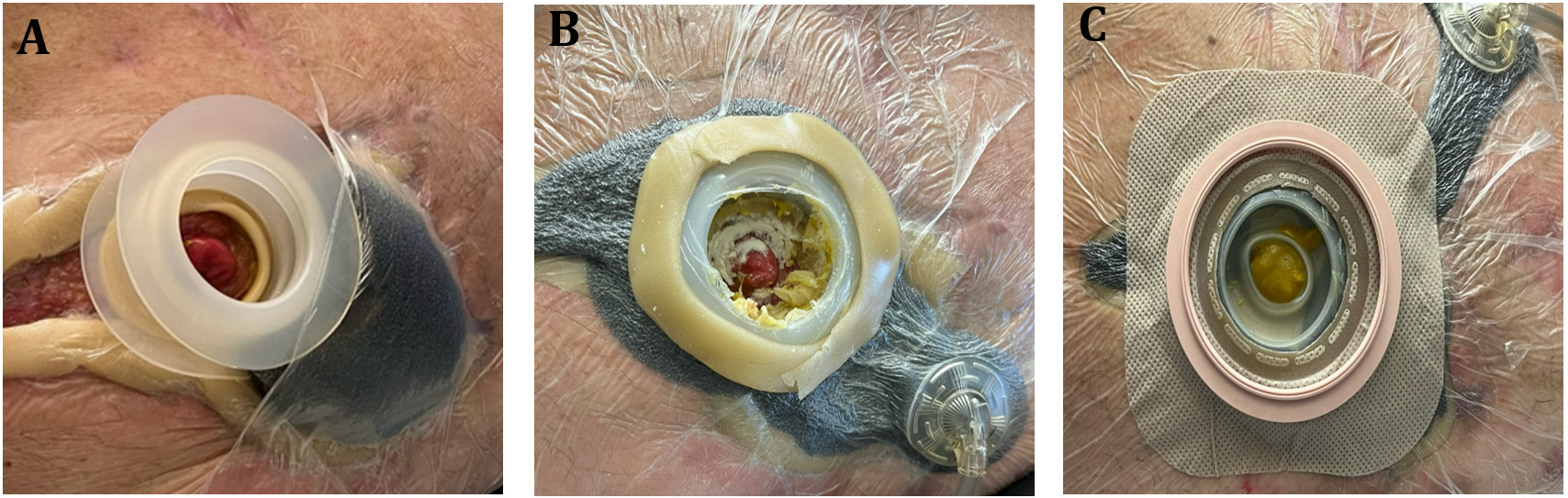 Management of an Abdominal Wall Wound in the Presence of an Entero ...