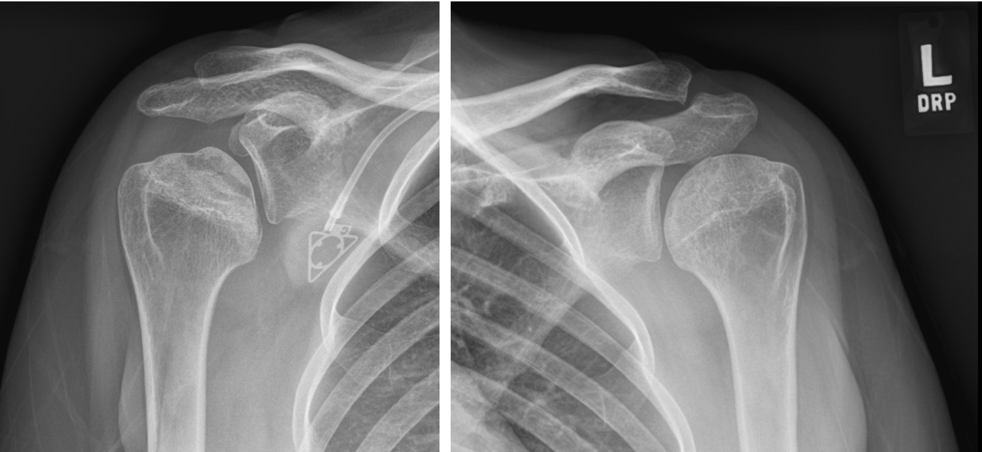 Review of Pyrocarbon Shoulder Hemiarthroplasty: Advances in Shoulder ...