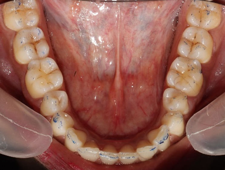 Trigeminal Neuralgia Improvements After Disclusion Time Reduction (DTR ...