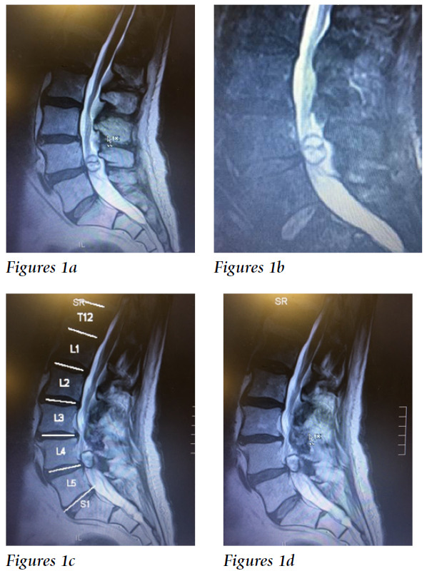 COX FLEXION-DISTRACTION UTILIZED IN THE MANAGEMENT OF A LOWER BACK PAIN ...