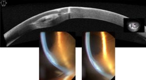 Case Report of Corneal Allogenic Intrastromal Ring Segment (CAIRS) in a ...