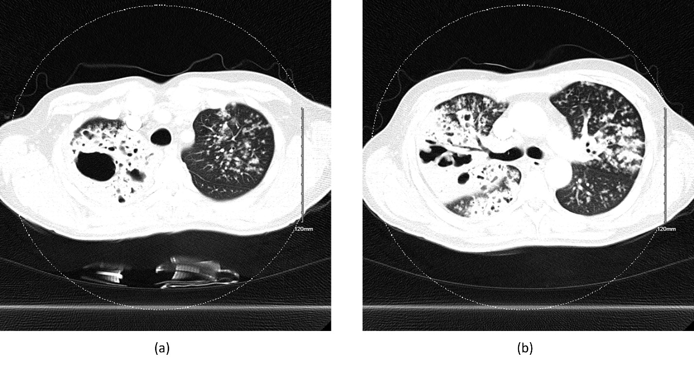 Incidental Spontaneous Pneumothorax in a Patient with Recently ...