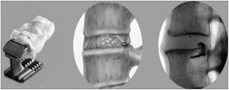 Interventional Therapy and Surgical Management of Lumbar Disc ...