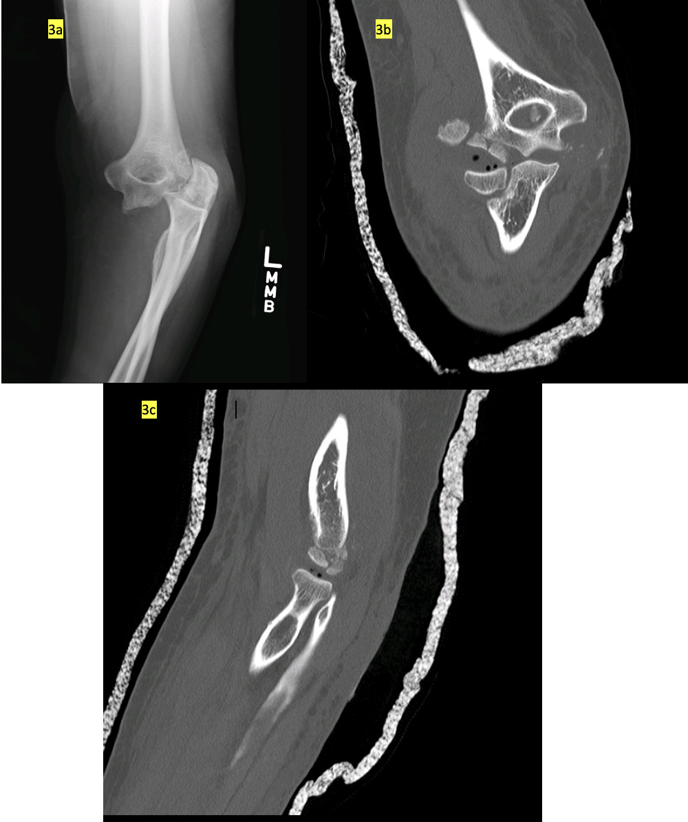 Capitellum Fracture: Surgical Exposure and Fixation Strategies ...
