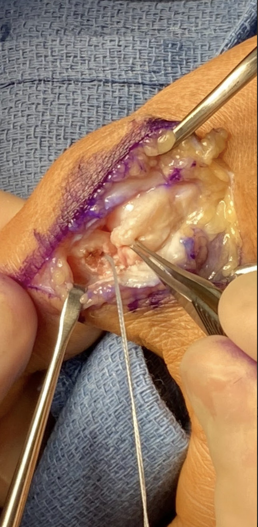 Early Experience in Collateral Ligament Repair of the Hand with the use ...