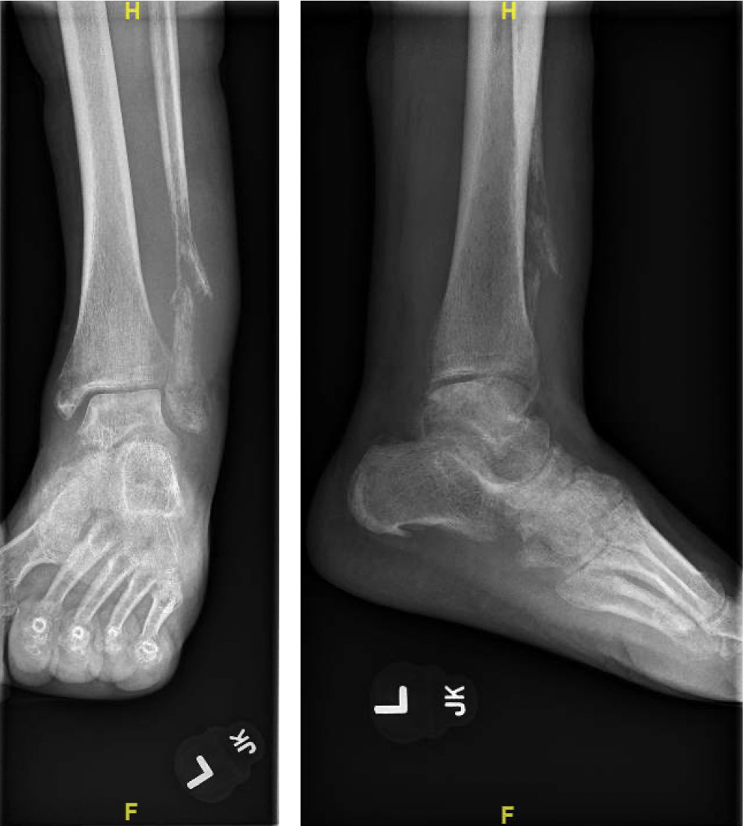 Distal Fibular Metastasis of Colorectal Carcinoma: A Case Report ...