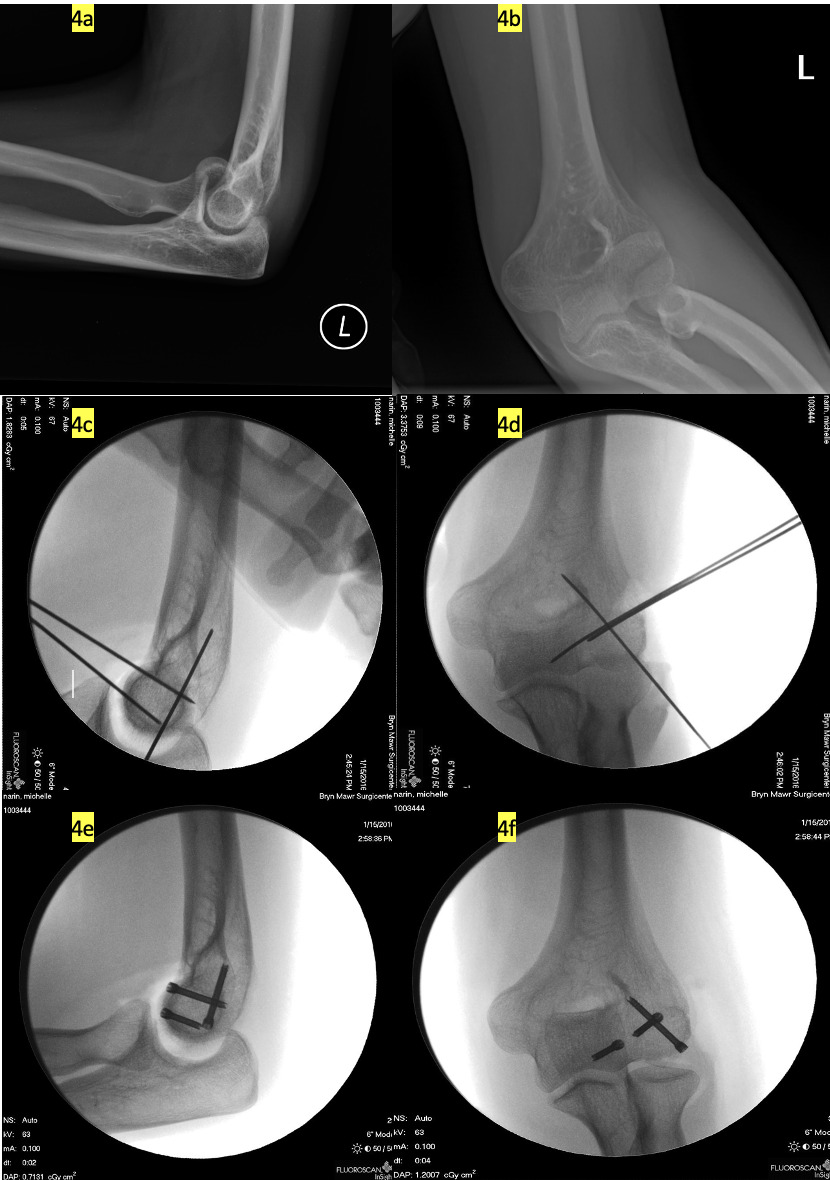 Capitellum Fracture: Surgical Exposure and Fixation Strategies ...