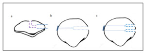 Medial patellofemoral ligament reconstruction using an endobutton ...