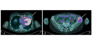 Elranatamab treatment in a multiple myeloma patient undergoing renal ...