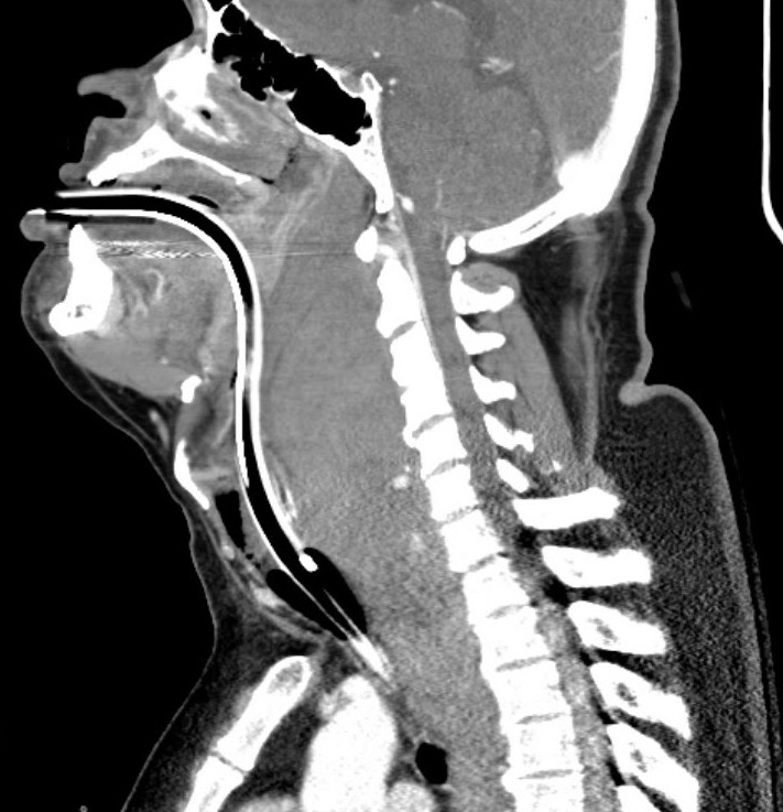 Airway management in acute hematoma formation following anterior ...
