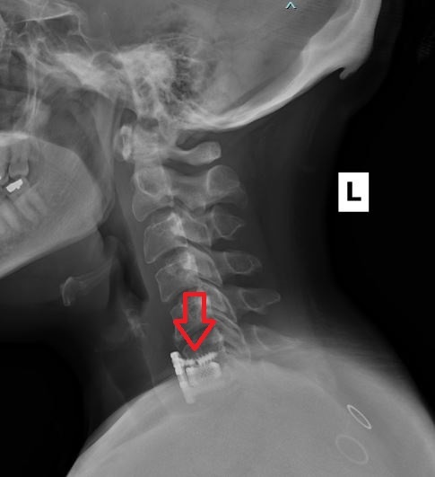 Cervical Epidural Steroid Injection for Cervical Radicular Pain in a ...