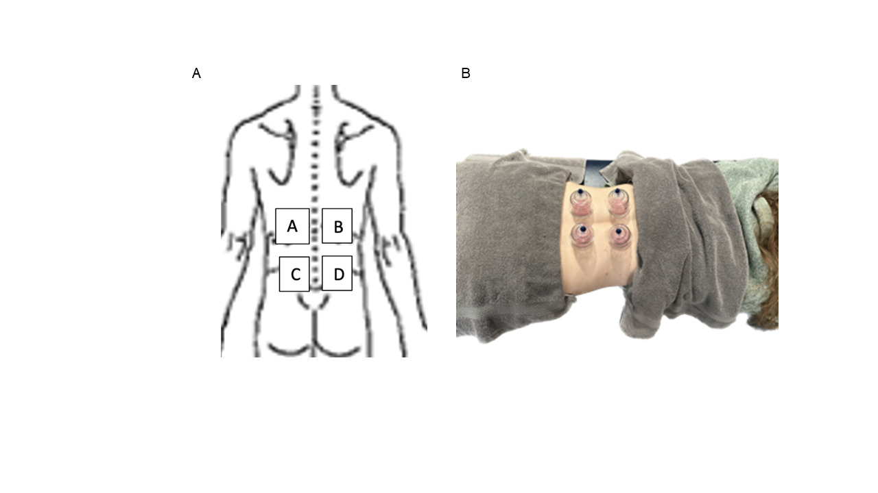 Combining Static and Dynamic Myofascial Dry Cupping Therapy to Improve ...