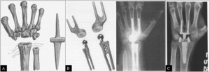 The Evolution & Outcomes of Total Wrist Arthroplasty: Current Concepts ...