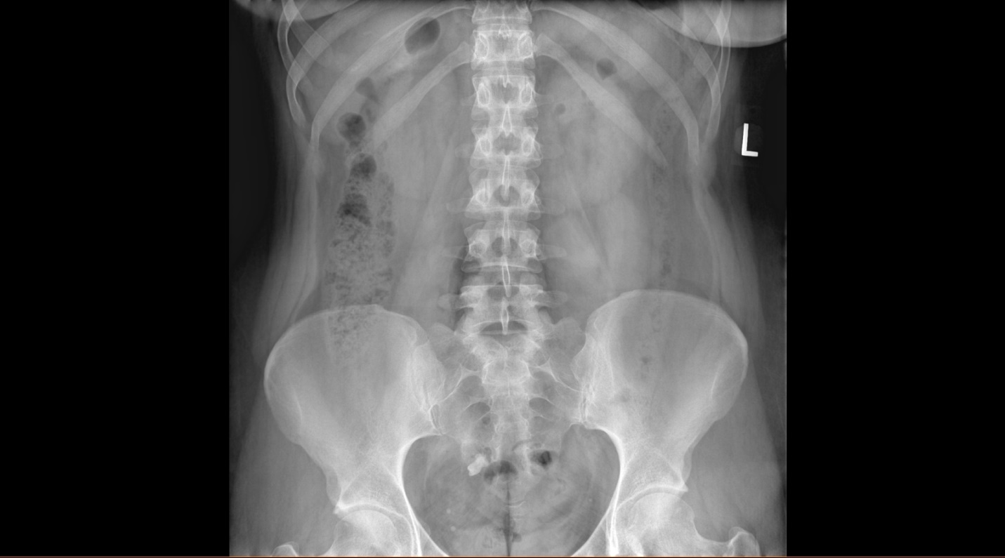 LOW BACK PAIN WITH INCIDENTAL TERATOMA | Published in Journal of ...