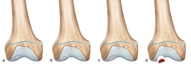 An update on osteochondritis dissecans of the knee | Published in ...