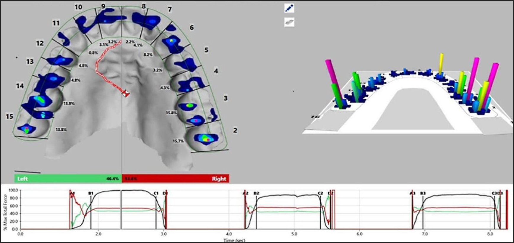 Digital Occlusion Analyzers: A Product Review of T-Scan 10 and ...