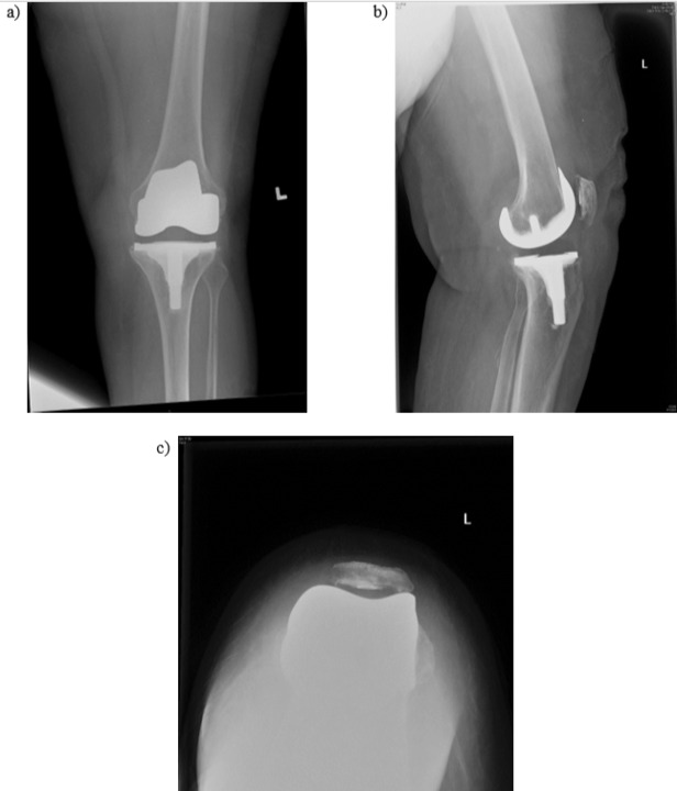superimposed cppd arthropathy