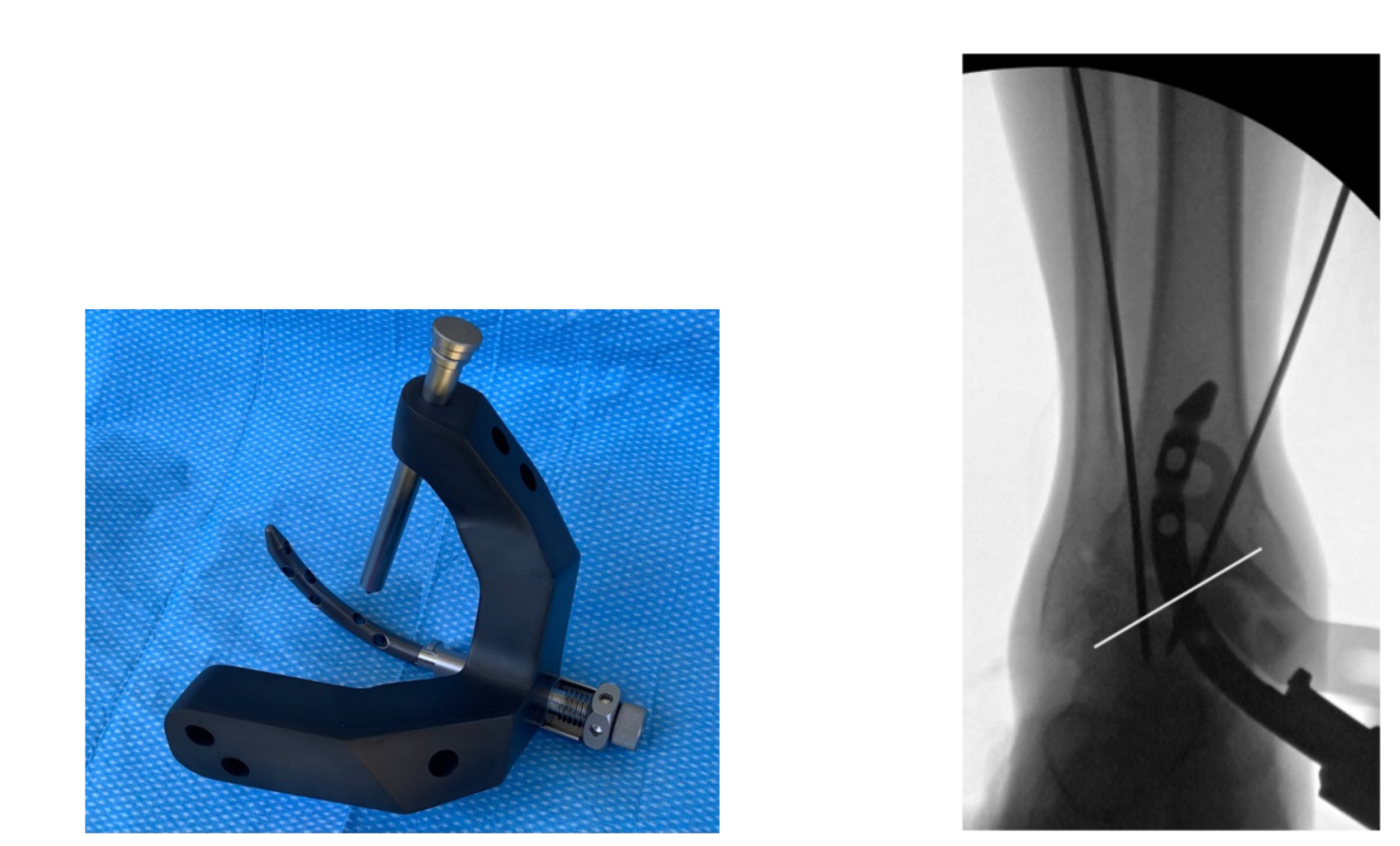A New Technique For Tibiotalar Arthrodesis: Shotel Ankle Arthrodesis ...