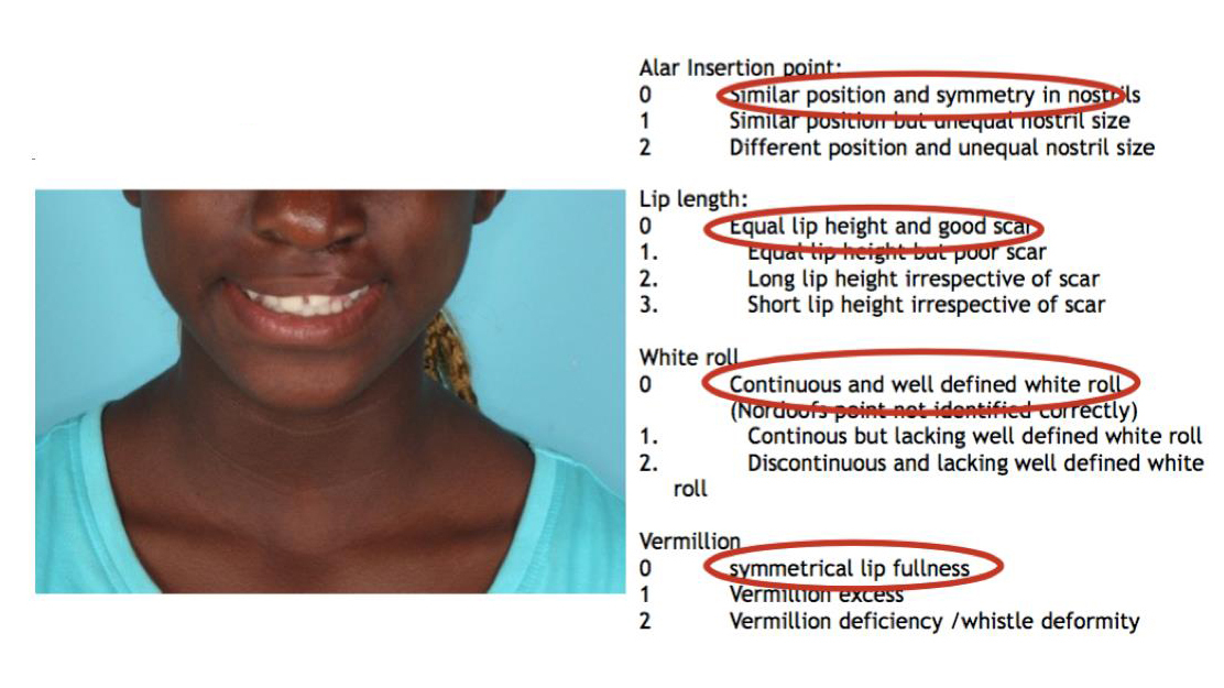 Perth scoring system for assessment of the cleft lip | Published in ...