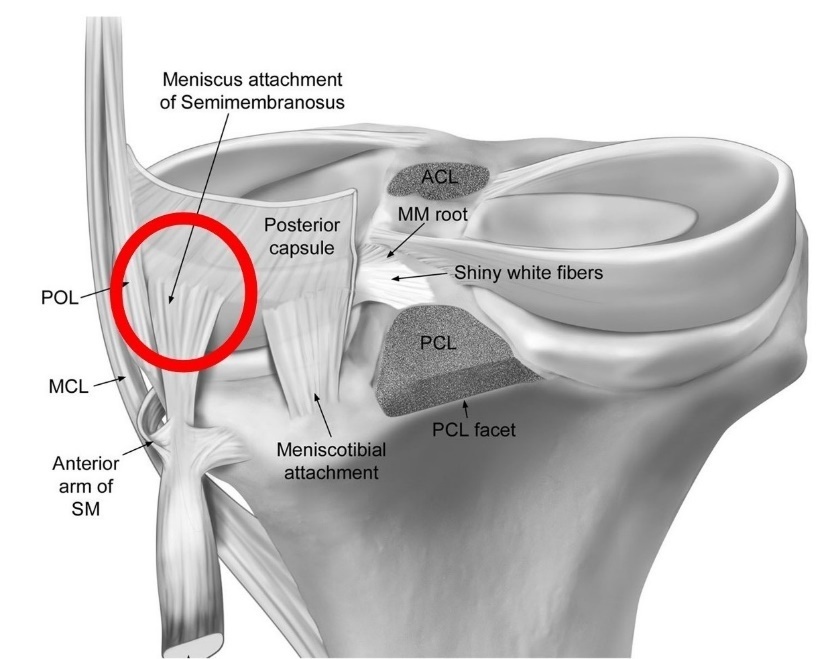 Posterior Medial Meniscus Root Tears: Clinical Implications, Surgical ...