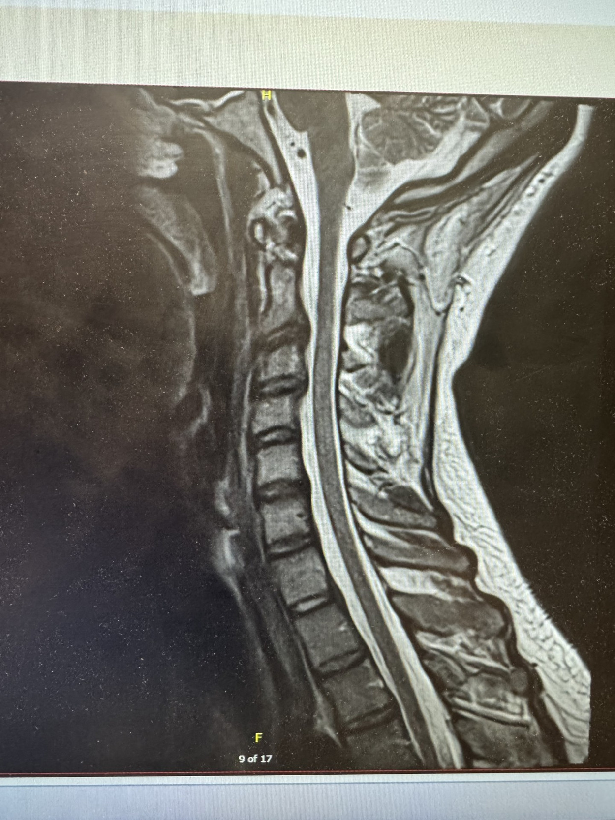 THE RIB THAT WOULDN'T QUIT: A CHIROPRACTIC PERSPECTIVE ON RECURRENT ...