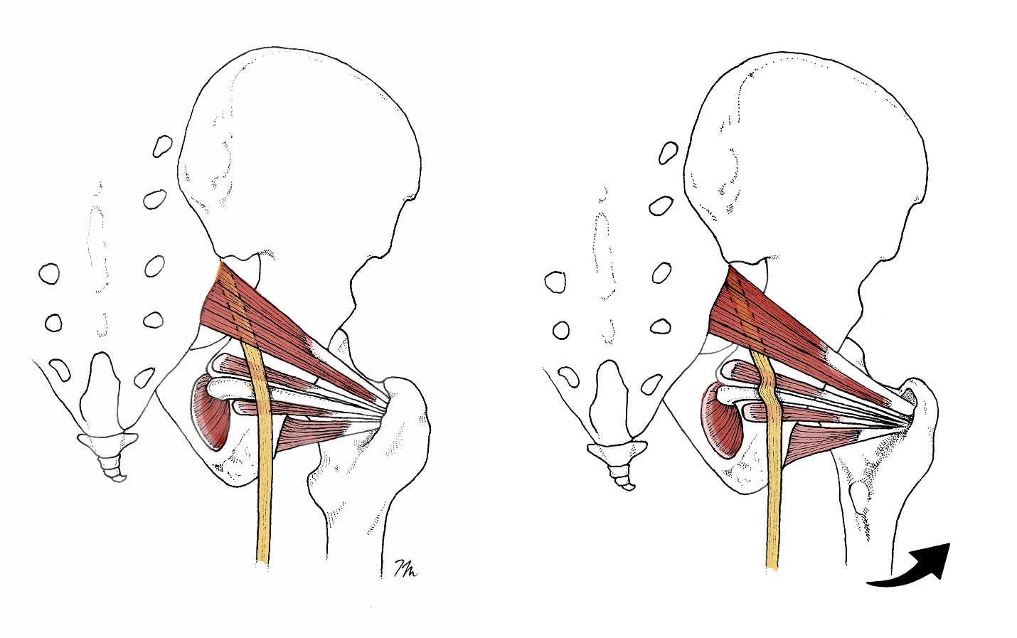 OBTURATOR INTERNUS CONTRACTURE: AN UNDERAPPRECIATED CAUSE OF PELVIC FLOOR AND SCIATIC PAIN ...