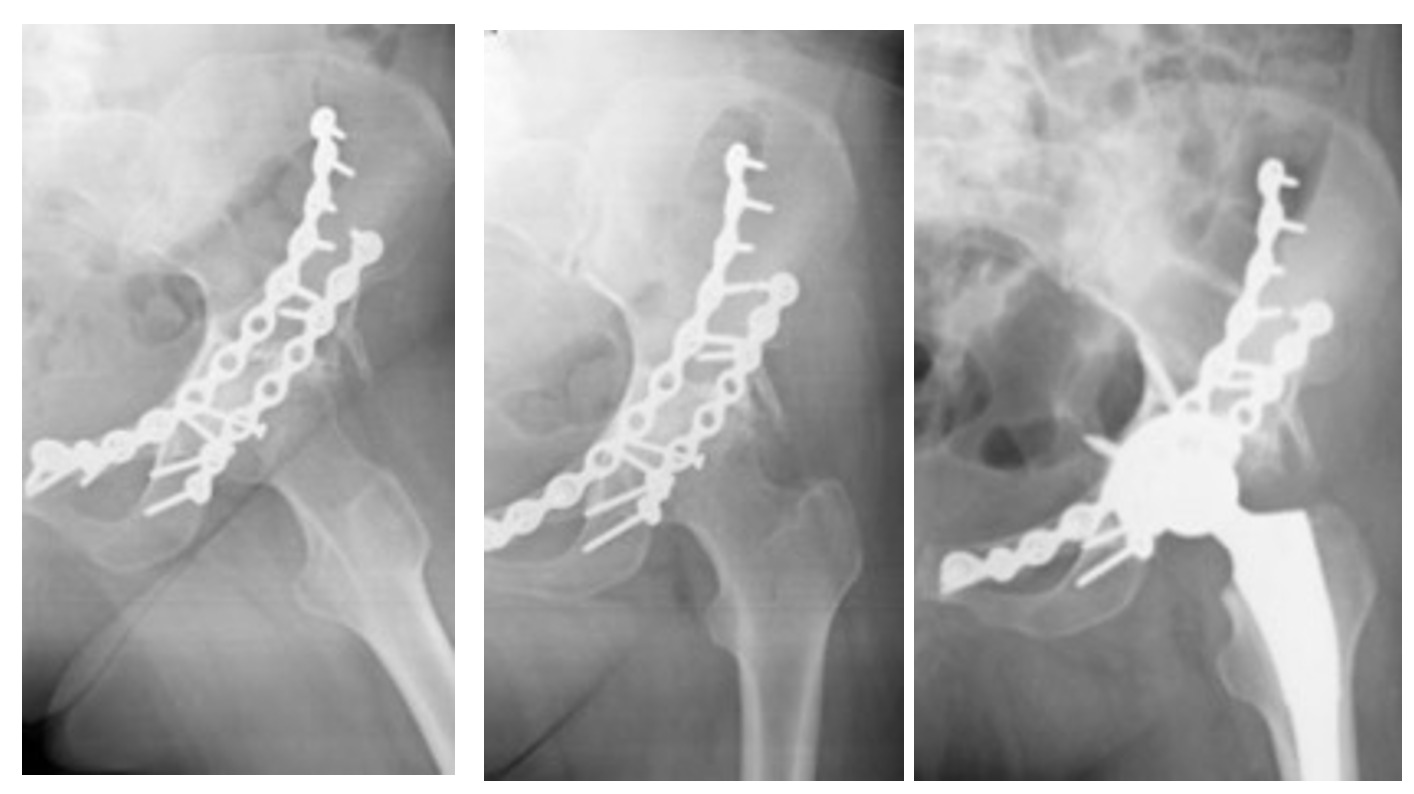 WHICH PROBLEMATICS IN THA AFTER ACETABULAR FRACTURES: EXPERIENCE OF 38 ...