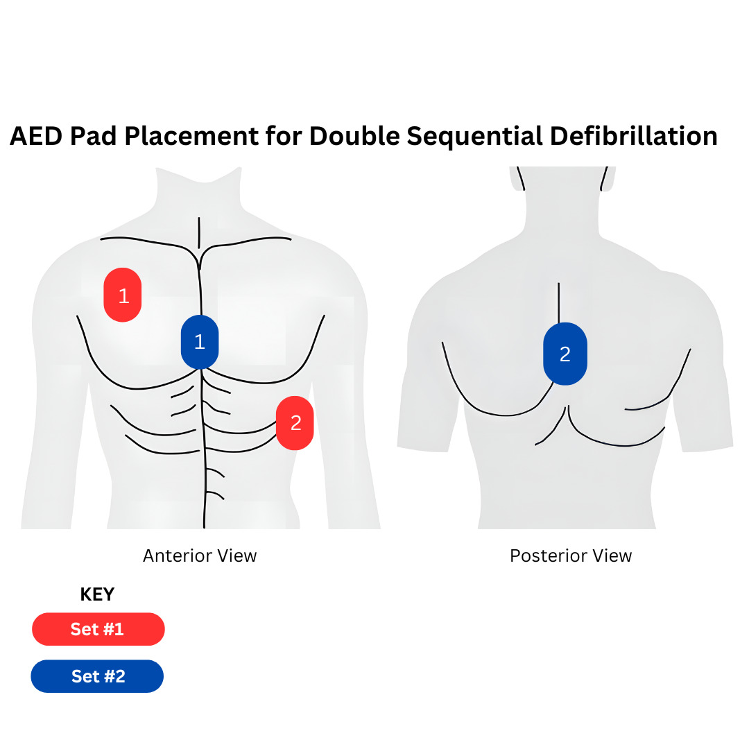 Double Sequential Defibrillation For Refractory Ventricular