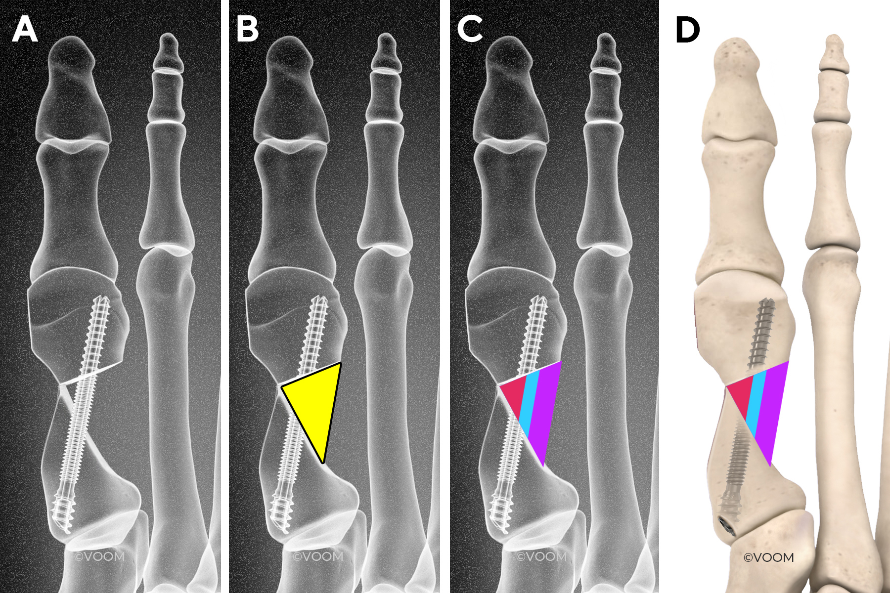 Characterization Of First Metatarsal Regeneration After New Modern ...