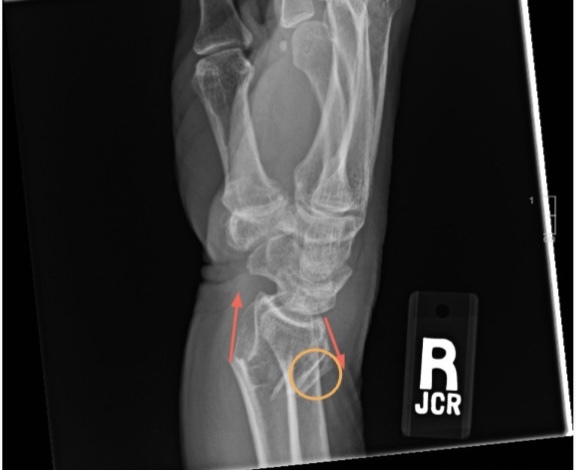 Distal Radius Fracture with Dorsal Angulation | Published in Orthopedic ...