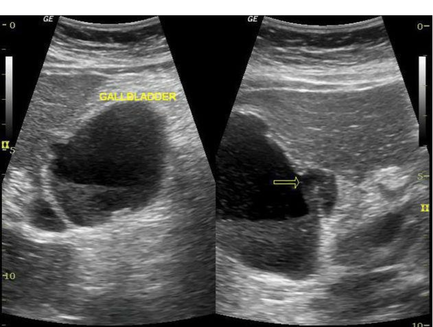 An overview of the management of gallbladder perforations. | Published ...