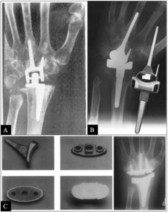 The Evolution & Outcomes of Total Wrist Arthroplasty: Current Concepts ...