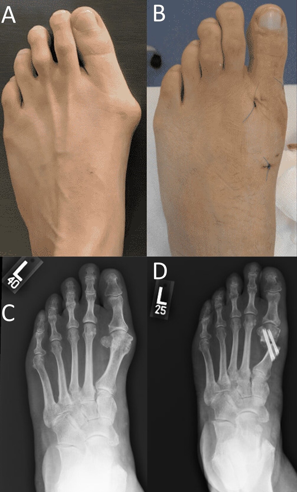 Minimally Invasive Bunion Surgery for Hallux Valgus: A surgical ...