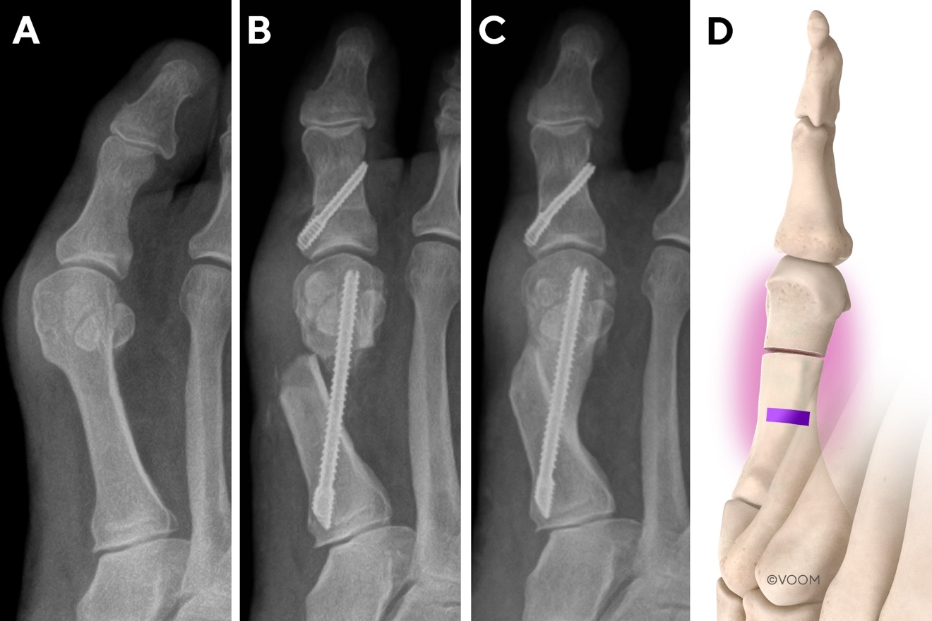 Defining the Cortical Purchase Zone in New Minimally Invasive Bunion ...