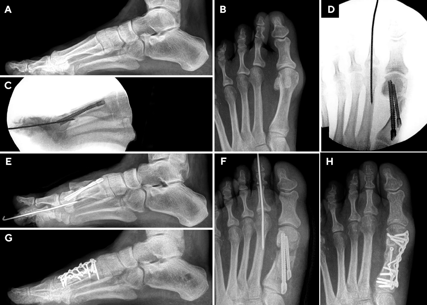 Patterns of Metatarsal Explosion After New Modern Minimally Invasive ...