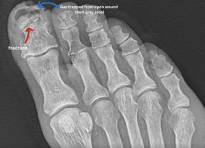 Traumatic Hallux Fracture | Published in Orthopedic Reviews