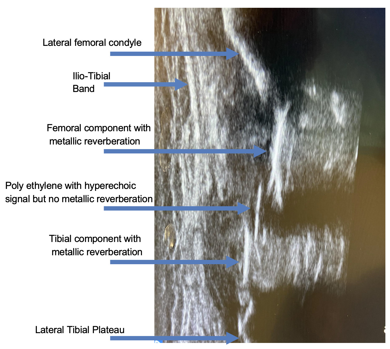 Isolated lateral-sided knee pain in total knee arthroplasty. A review ...