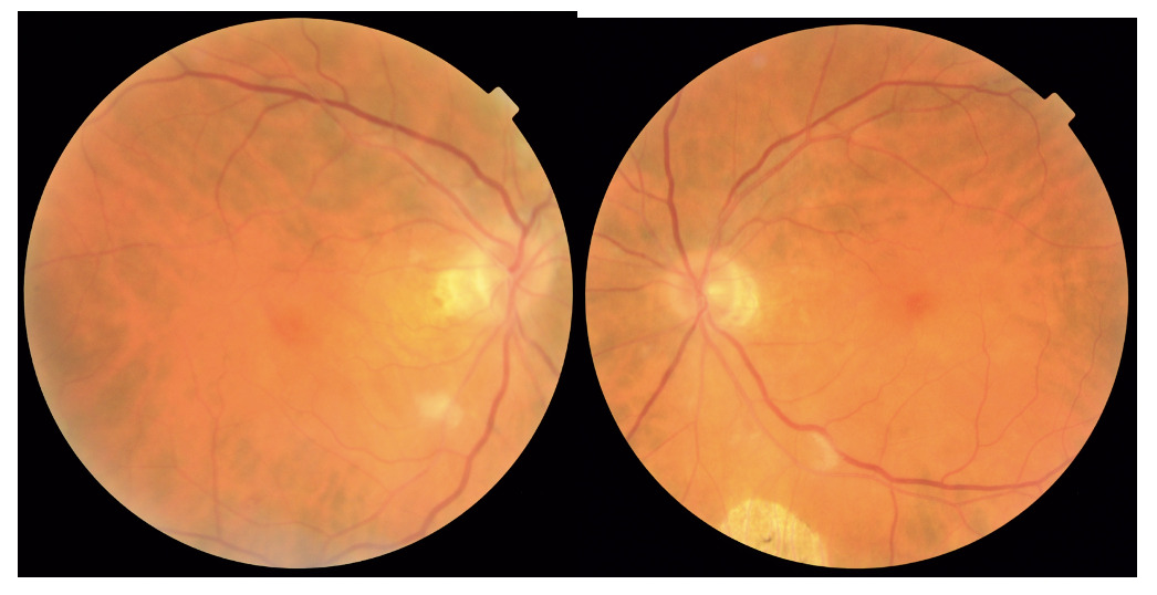 Case Report: A Case of Anemic Retinopathy in Severe Microcytic Anemia ...