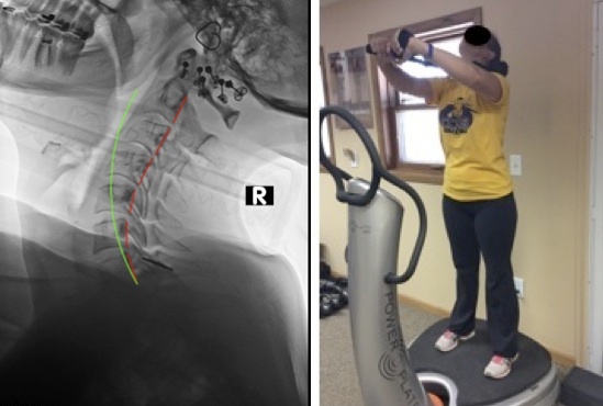 CHIROPRACTIC BIOPHYSICS MANAGEMENT OF STRAIGHT BACK SYNDROME AND ...
