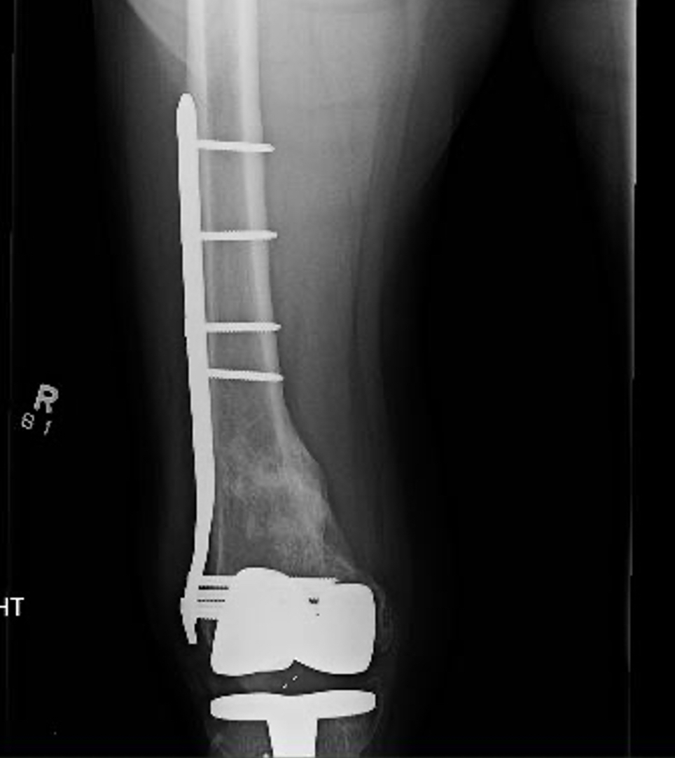 Early Weight Bearing after Distal Femur Fractures in the Elderly: A ...