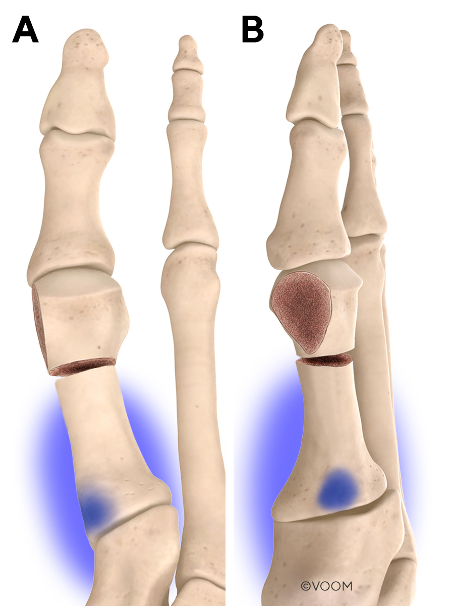 Patterns of Metatarsal Explosion After New Modern Minimally Invasive ...