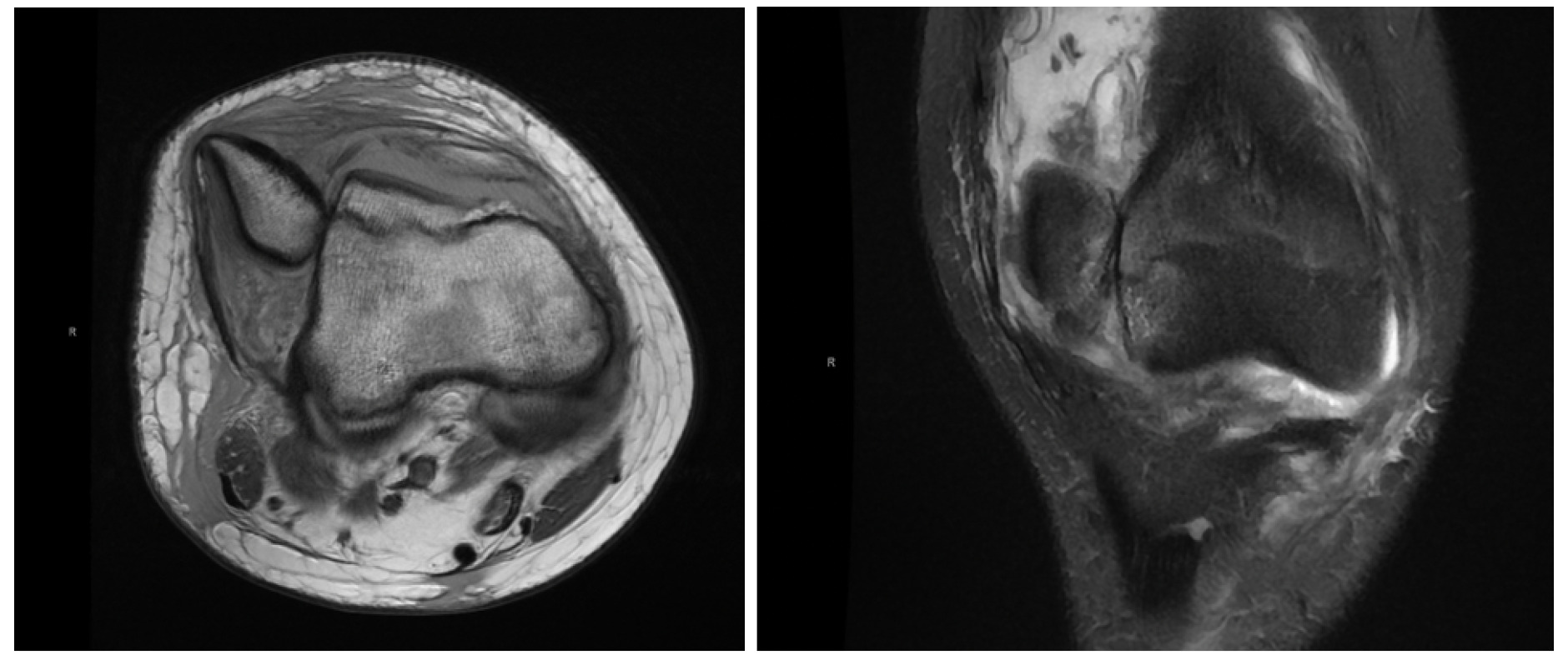 Irreducible lateral dislocation of the patella with vertical rotation ...