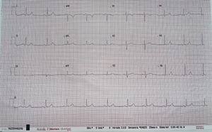 Coumadin Ridge | Published in Journal of Brown Hospital Medicine