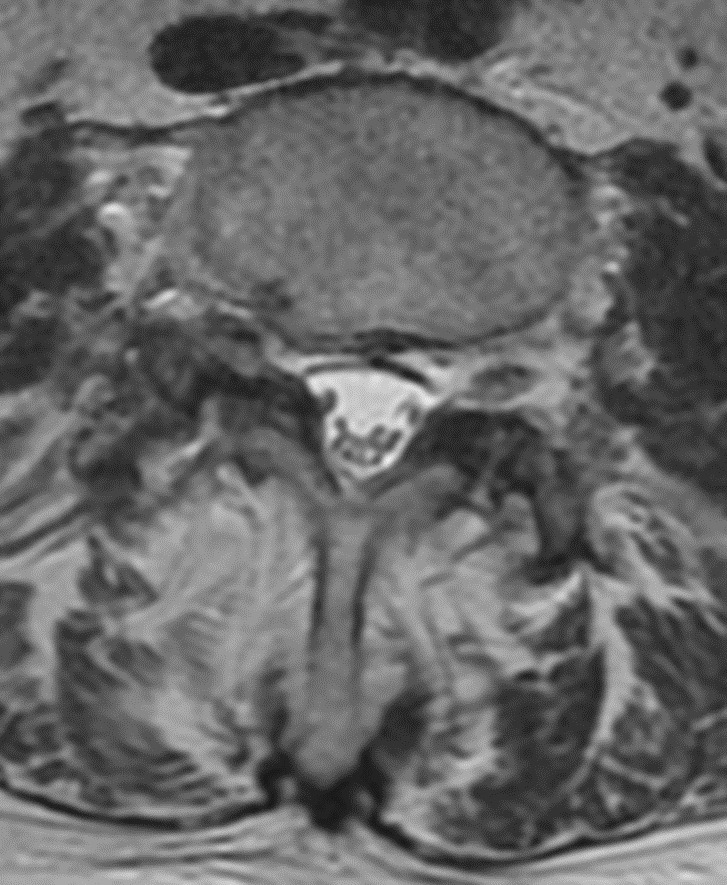 MANAGEMENT OF CHRONIC LOW BACK PAIN IN AN 80-YEAR-OLD FEMALE UTILIZING ...